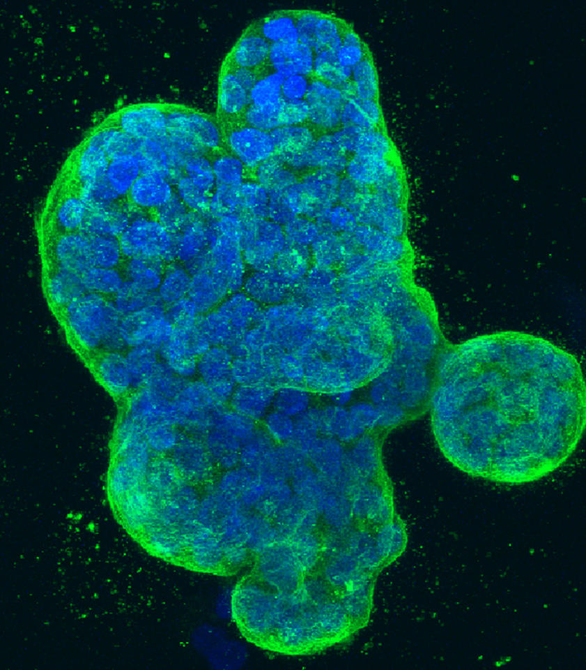 Three-dimensional culture of human breast cancer cells Three-dimensional culture of human breast cancer cells